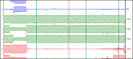 IntelliRupter® PulseCloser® Fault Interrupter